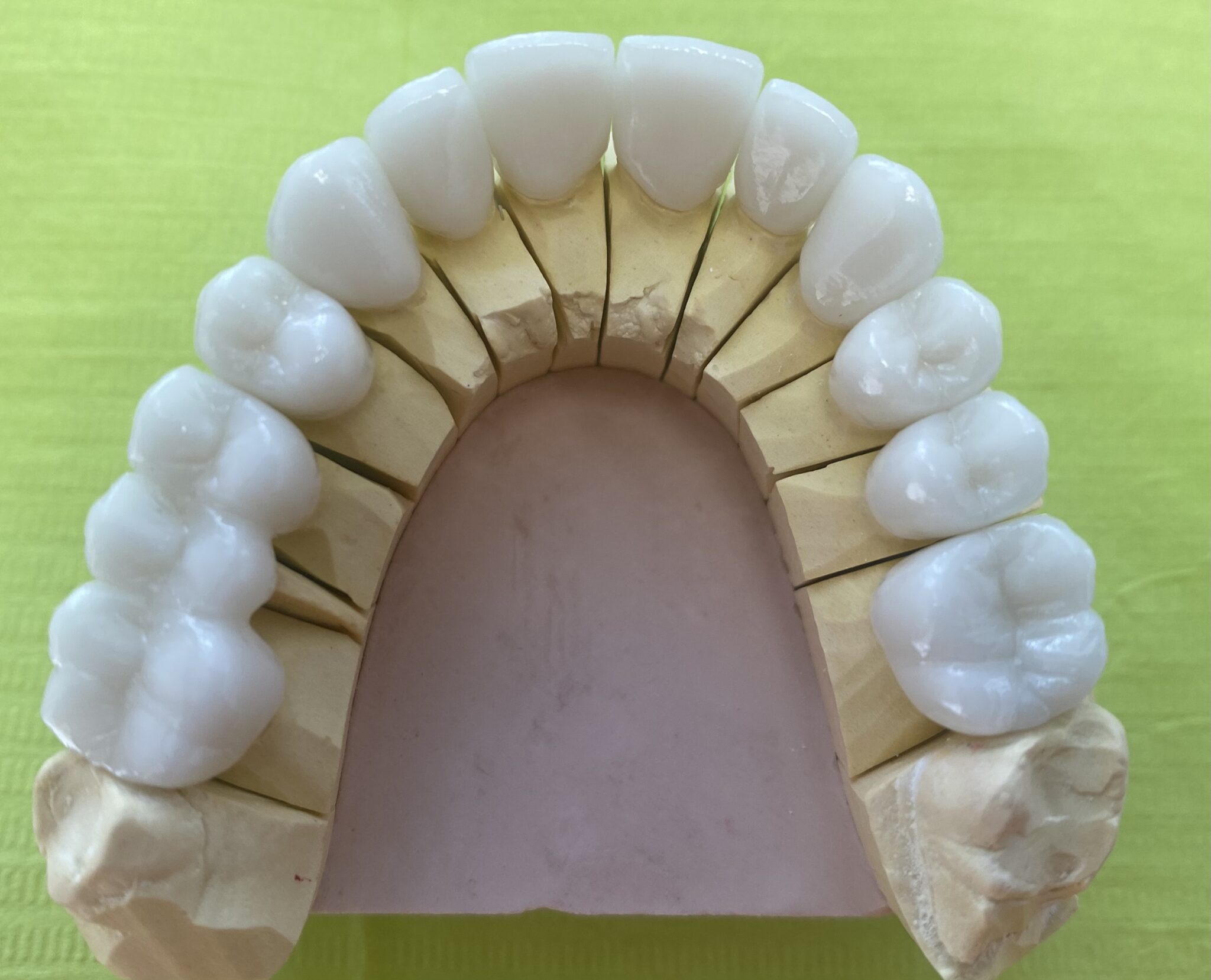 Prosthetic treatment with all-ceramic crowns / bridges in the upper ...